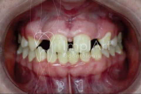 Agenesia dentária e a necessidade de implantes - Congênita