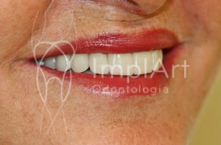 implante_dental_total - Clínica Odontológica de Implante Dentário