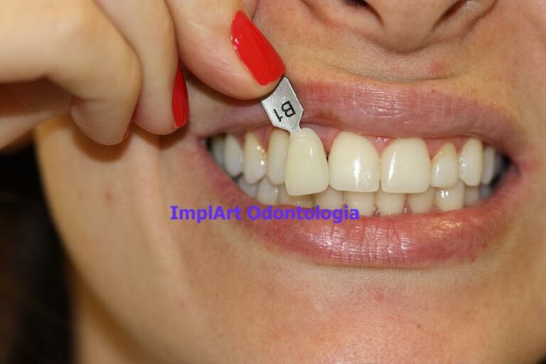 Encontre a Cor dos Dentes Ideal | Transformação do Sorriso