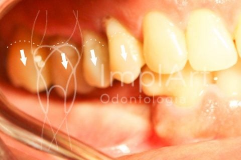 Ausências Dentárias: 5 problemas orais GRAVES causados