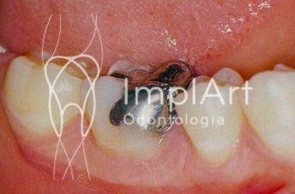 bloco-de-metal-onlay_7403701732_l - Clínica Odontológica de Implante ...