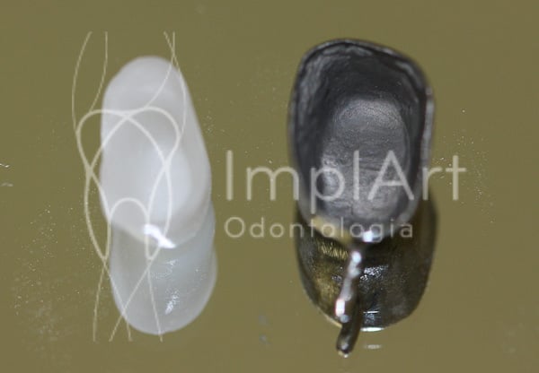 Coping metálico x coping em zircônia - vista interna_5223777303_l ...