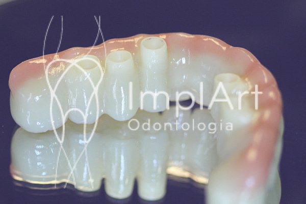 implantes dentarios - prótese fixa para implante total em zircônia ...