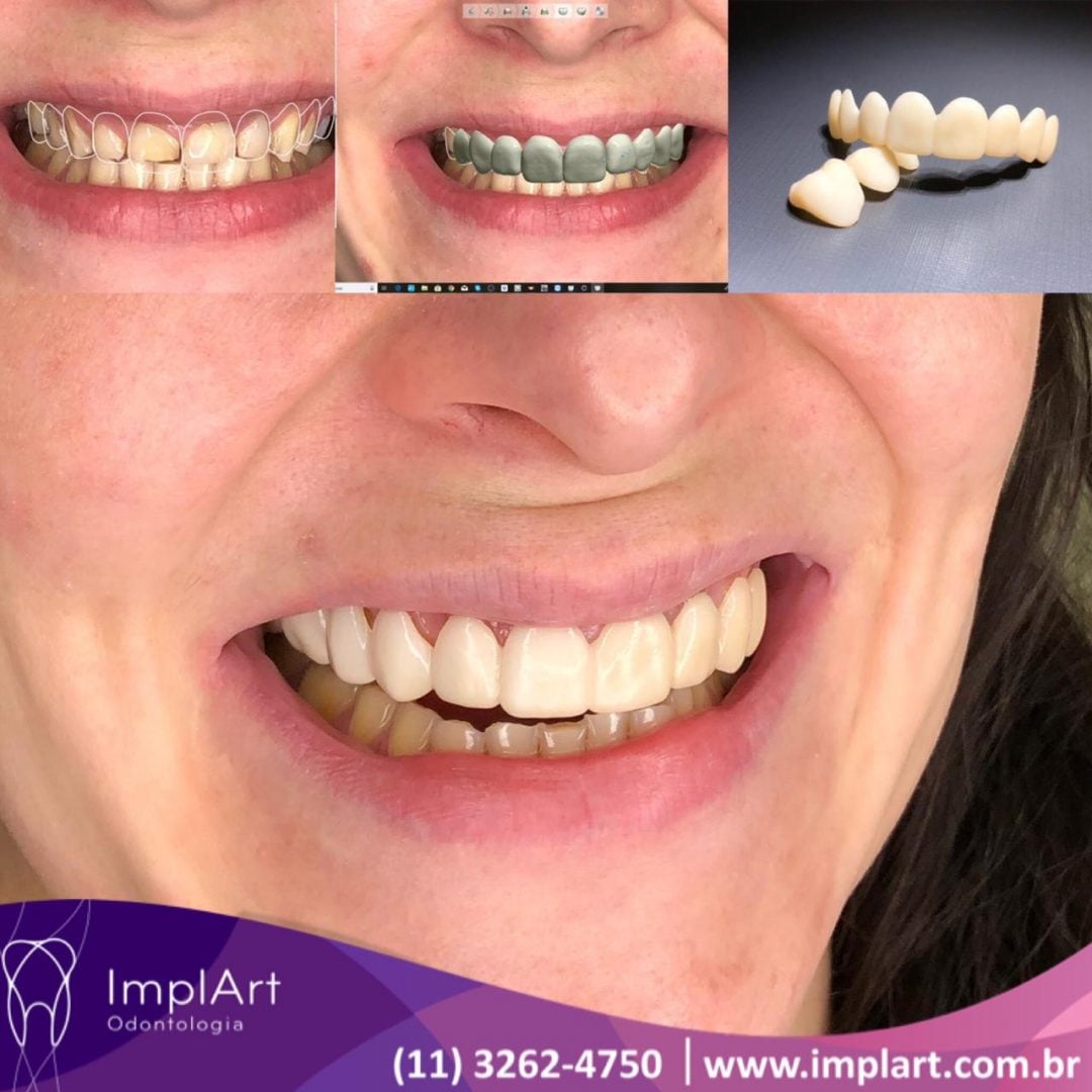 Implante dental: prótese provisória ajuda na estética final - Blog ImplArt