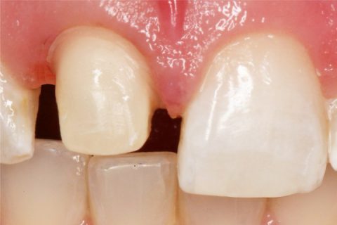 preparo_dente_incisivo_para_coroa_50kb - Clínica Odontológica de ...