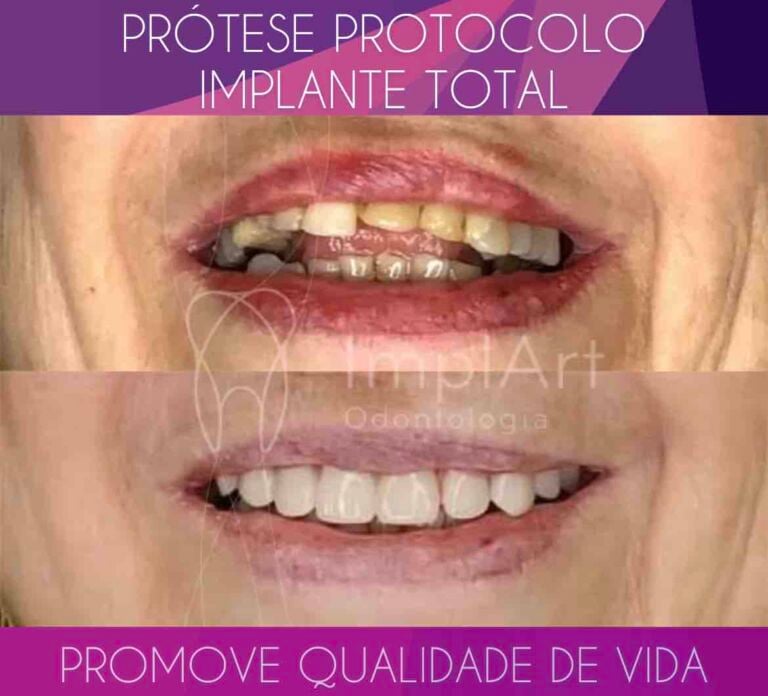 Prótese Protocolo em São Paulo: 1- O que é, Como Funciona