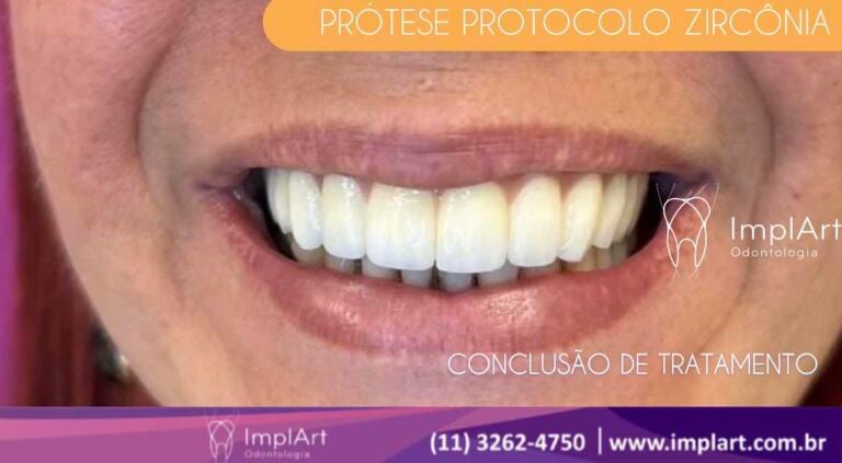 Prótese Protocolo em São Paulo: 1- O que é, Como Funciona