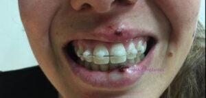 Dente Mole: O que é, Porque Ocorre, Tratamento e Prevenção