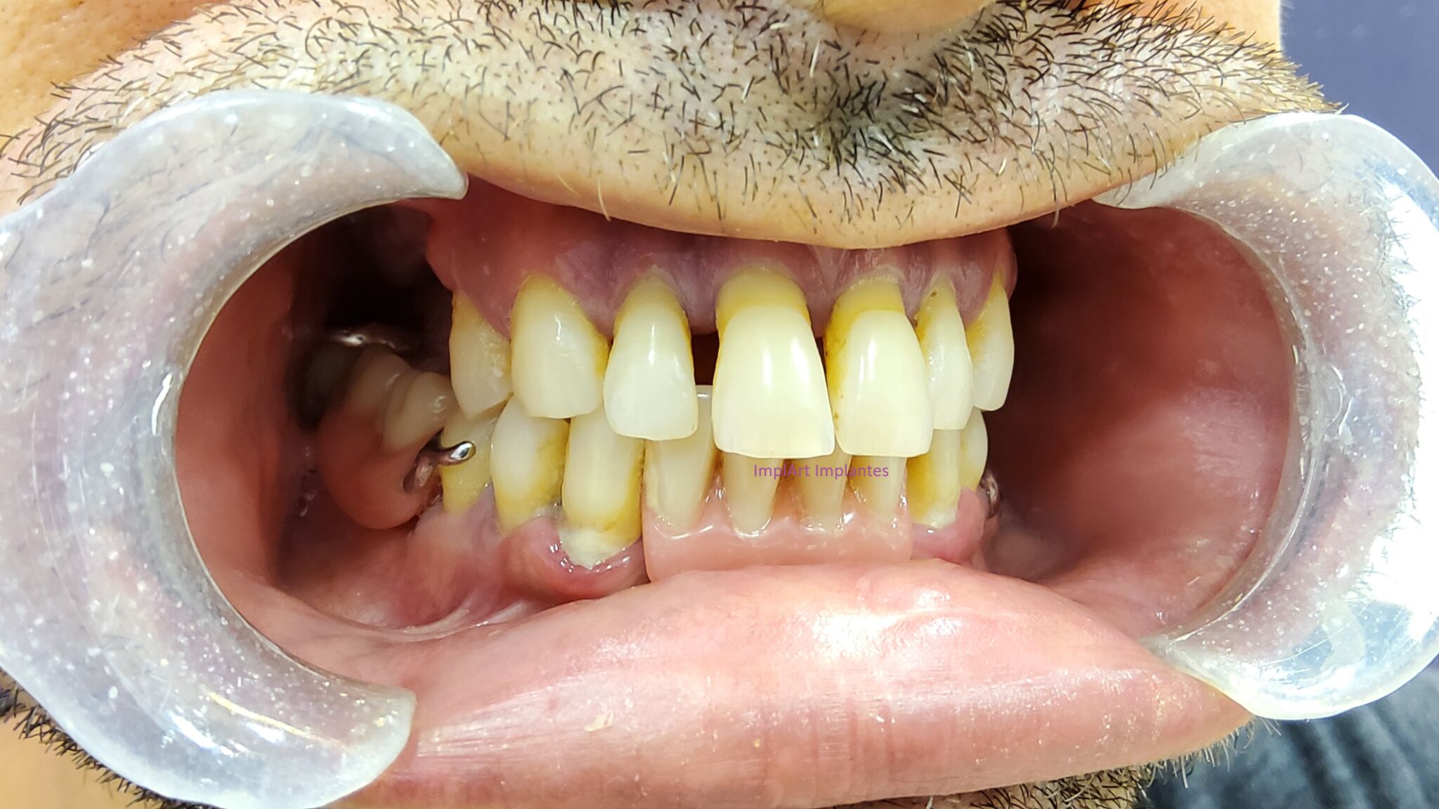 Dente Mole: O que é, Porque Ocorre, Tratamento e Prevenção